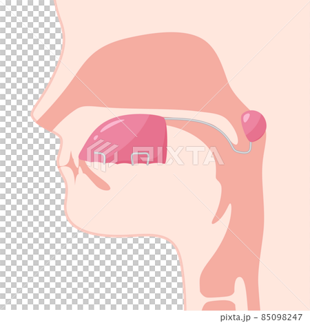 Cleft lip and palate_Illustration of sagittal... - Stock Illustration ...