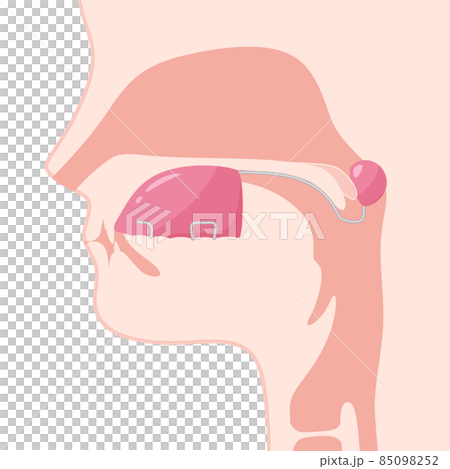 Cleft lip and palate_Illustration of sagittal... - Stock Illustration ...