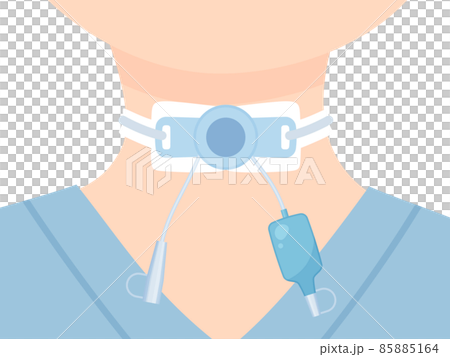Illustration with a tracheal cannula _ Cannula... - Stock Illustration ...