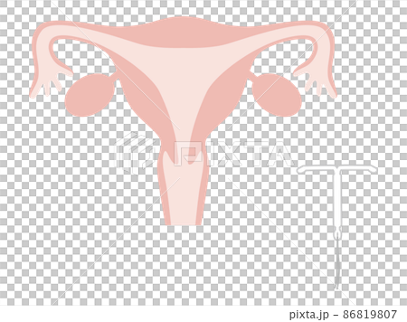 Intrauterine contraceptive system (IUS) and... - Stock Illustration ...