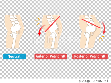 Pelvic tilt forward and backward tilt - Stock Illustration [87402931 ...