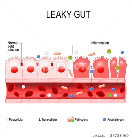 leaky gut. cells on gut lining held tightly...のイラスト素材 [87788460] - PIXTA