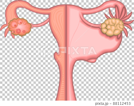 Uterine structure illustration - Stock Illustration [88112453] - PIXTA