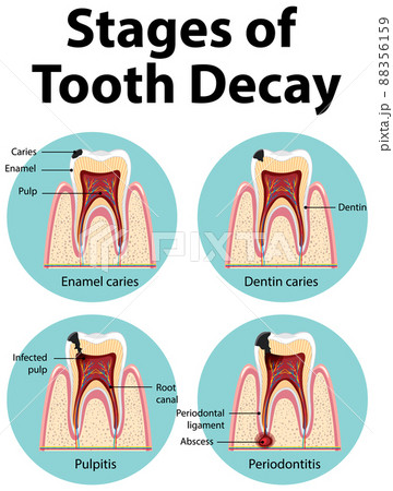 Infographic of human in the stages of tooth decayのイラスト素材 [88356159] - PIXTA