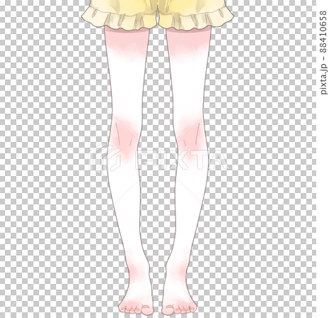 O-legged female legs - Stock Illustration [88410658] - PIXTA