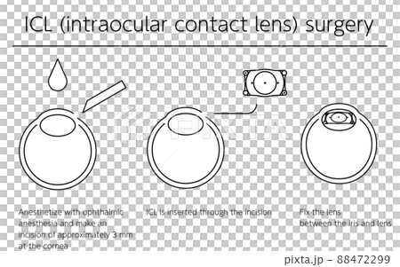 ICL (Intraocular Contact Lens) Surgery,... - Stock Illustration ...