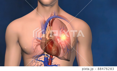 Blood clots are semi-solid masses of blood that...のイラスト素材 [88476283 ...