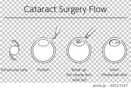 Flow of cataract surgery, illustrated... - Stock Illustration [88523387 ...