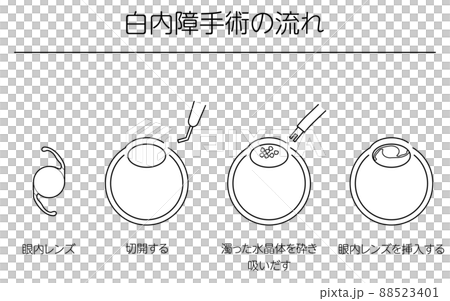 Flow of cataract surgery, illustrated... - Stock Illustration [88523401 ...