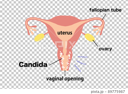 Vaginitis Illustration of a sick uterus - Stock Illustration [89775987 ...