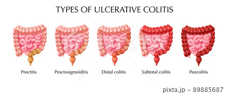 Ulcerative Colitis Types Infographicsのイラスト素材 [89885687] - PIXTA