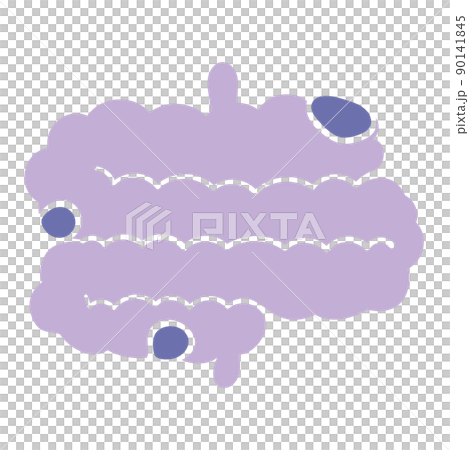 Tumored intestine - Stock Illustration [90141845] - PIXTA