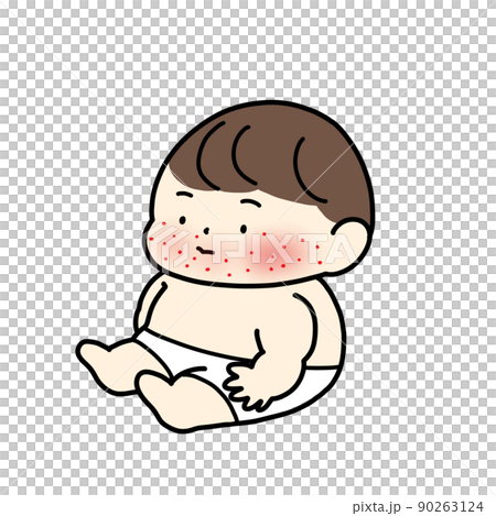 Baby with a rash on the face - Stock Illustration [90263124] - PIXTA
