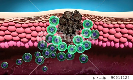 cells destroy cancer 3d medicalのイラスト素材 [90611122] - PIXTA