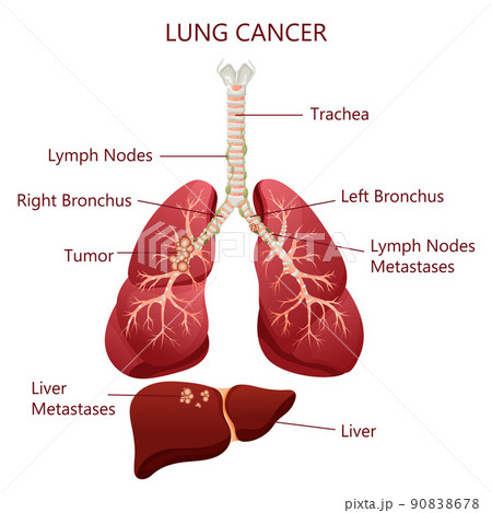 Lung Cancer Tumor Diagram
