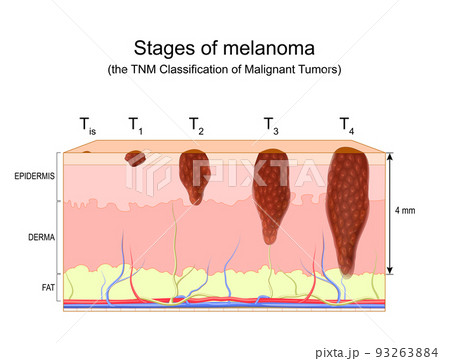 stages of melanoma. The TNM Classification of...のイラスト素材 [93263884] - PIXTA