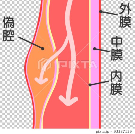 acute aortic dissection - Stock Illustration [93387139] - PIXTA