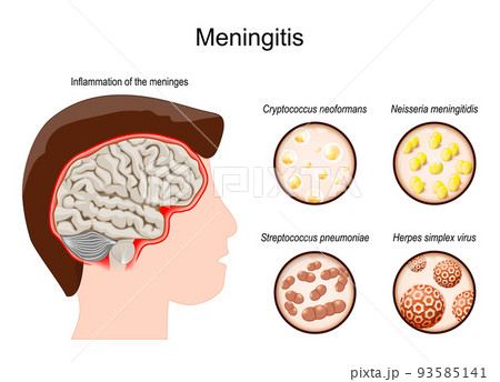 Meningitis. Human's brainのイラスト素材 [93585141] - PIXTA