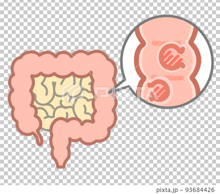 Explanation illustration of colon polyps - Stock Illustration [93684426 ...