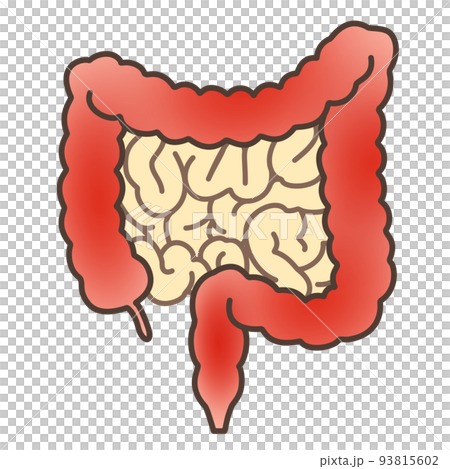 Ulcerative colitis - Stock Illustration [93815602] - PIXTA