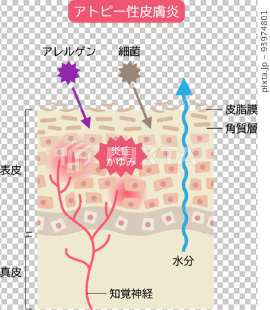 Mechanism of atopic dermatitis Skin cells and... - Stock Illustration ...