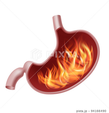 Burning stomach. Realistic human organ of...のイラスト素材 [94166490] - PIXTA
