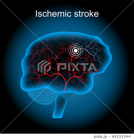 Cerebral infarction. ischemic stroke. human brainのイラスト素材 [94233344] - PIXTA
