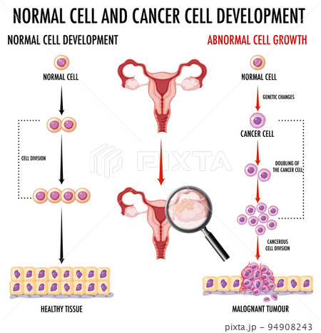 Diagram showing normal and cancer cells in humanのイラスト素材 [94908243] - PIXTA