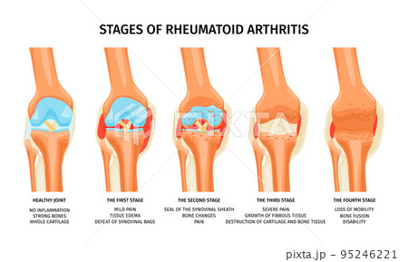 Rheumatoid Arthritis Stages Infographicsのイラスト素材 [95246221] - PIXTA
