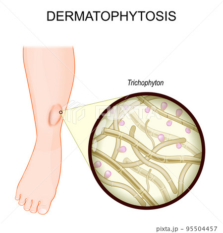 Dermatophytosis. Ringworm on a human leg.のイラスト素材 [95504457] - PIXTA
