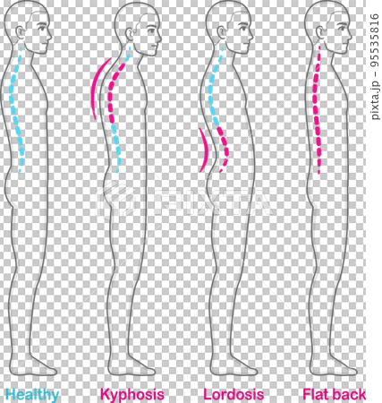 Posture and back problems spine infographic - Stock Illustration ...