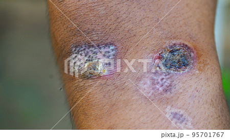 Scraped Knee Infection