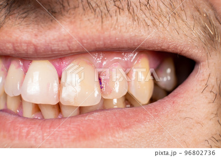 Plaque on human teeth is colored pink with...の写真素材 [96802736] - PIXTA