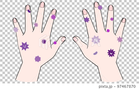 Back of hands Illustration of hands full of germs - Stock Illustration ...