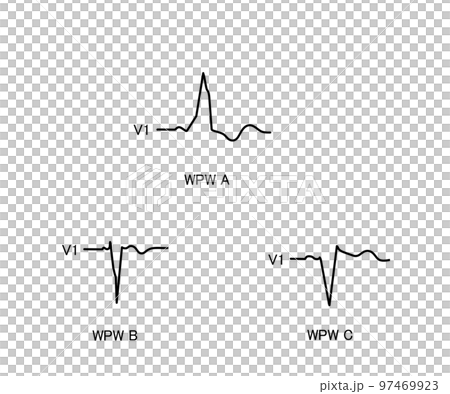 WPW症候群の心電図のイラスト素材 [97469923] - PIXTA