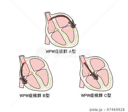 WPW症候群（A/B/C）のイラスト素材 [97469926] - PIXTA