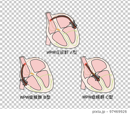 WPW Syndrome (A/B/C) - Stock Illustration [97469926] - PIXTA