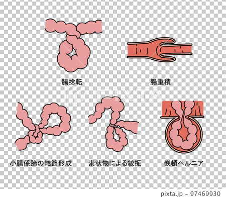 strangulation ileus - Stock Illustration [97469930] - PIXTA