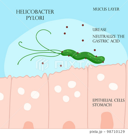 Helicobacter pylori in mucosal layer in stomach...のイラスト素材 [98710129 ...