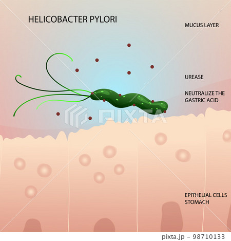 Helicobacter pylori on epithelial cells in...のイラスト素材 [98710133] - PIXTA