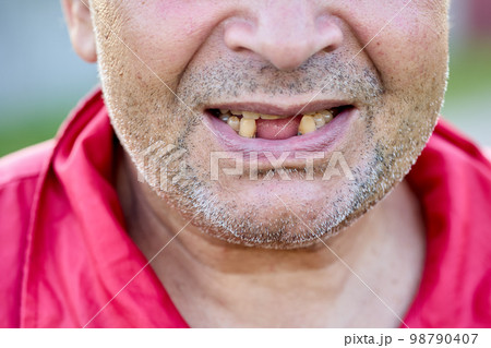 Toothless Caucasian middle aged man, lower part...の写真素材 [98790407] - PIXTA