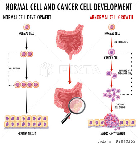 Diagram showing normal and cancer cells in humanのイラスト素材 [98840355] - PIXTA