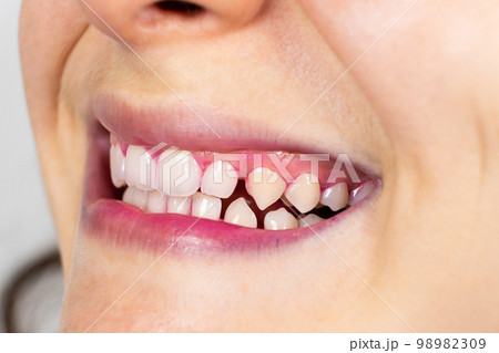 Plaque on human teeth is colored pink with...の写真素材 [98982309] - PIXTA