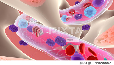 Lymphoblasts invaded and eventually replace...のイラスト素材 [99690002] - PIXTA
