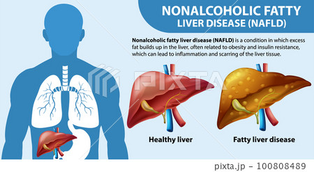 Nonalcoholic Fatty Liver Disease (NAFLD)のイラスト素材 [100808489] - PIXTA