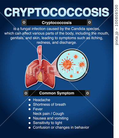 Informative poster of Cryptococcosisのイラスト素材 [100808500] - PIXTA