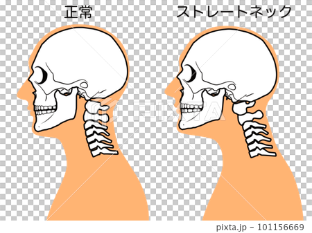 Normal cervical spine and straight neck - Stock Illustration [101156669 ...