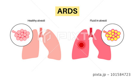 ARDS anatomical posterのイラスト素材 [101584723] - PIXTA