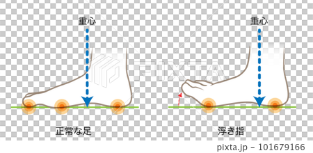 Center of gravity of normal foot and center of... - Stock Illustration ...