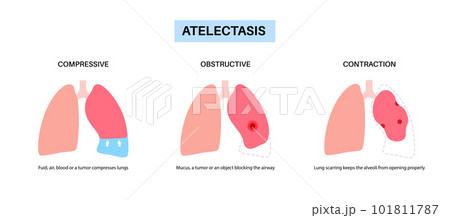 Atelectasis medical posterのイラスト素材 [101811787] - PIXTA